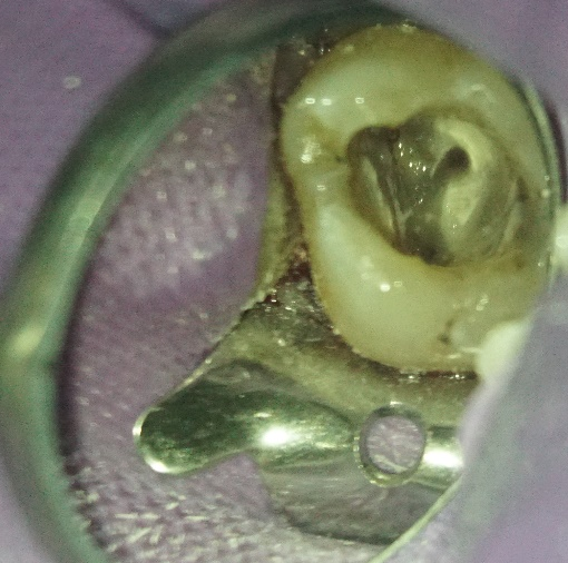 Root Canal Treatment - Gareth Thomas